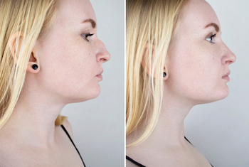 Nose Job Results: How To Get The Nose Of Your Dreams