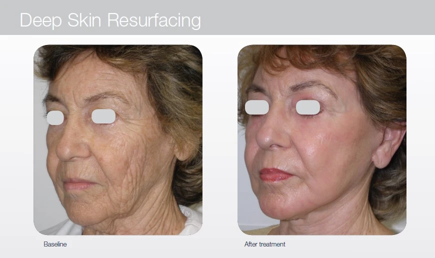 Laser Skin Resurfacing Sydney | Dr Alan Evans