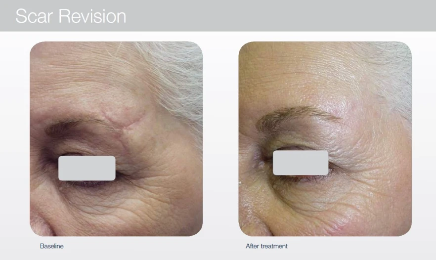 Laser Skin Resurfacing Sydney | Dr Alan Evans