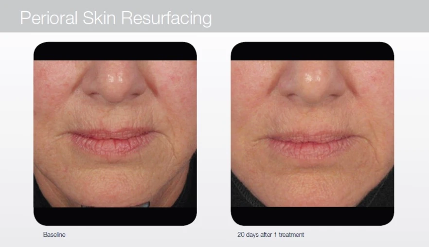 Laser Skin Resurfacing Sydney | Dr Alan Evans